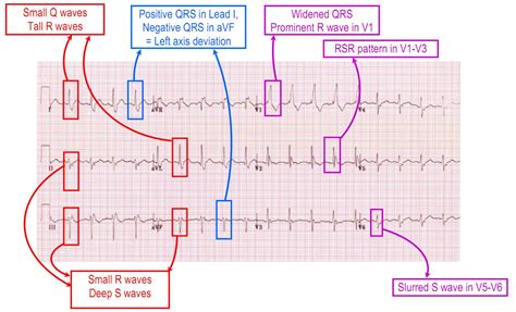Bifascicular And Trifascicular Block Deranged Physiology