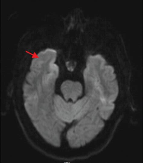 Mri Findings In A Patient With Herpes Simplex Virus Encephalitis A
