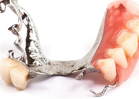 Protezat E Dhëmbeve Dentaristo