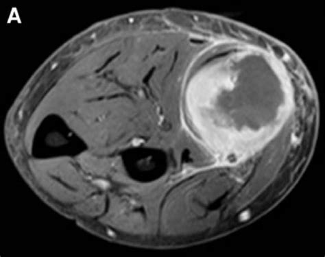 Soft Tissue Sarcoma Pathology Orthobullets