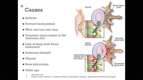 Cervical Stenosis Overview Youtube