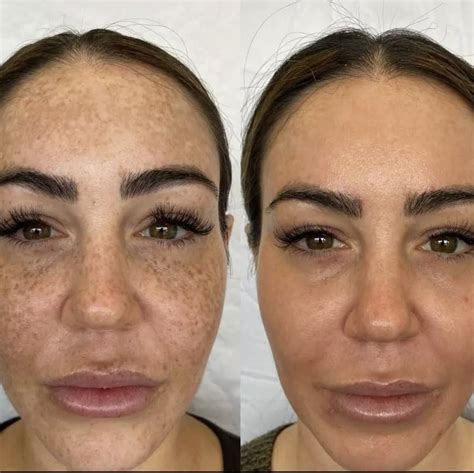 Cosmelan Peel In New Orleans Regenesis Medical Spa And Laser Skin Clinic