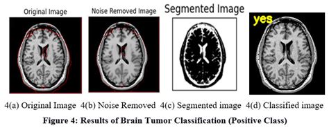 Real Time Multi Fractal Ensemble Analysis Cnn Model For Optimizing Brain Tumor Classification