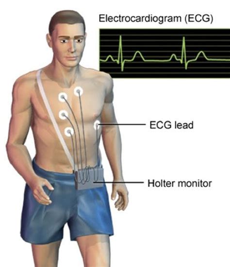 24 Hour Holter Monitor North Side Cardiology