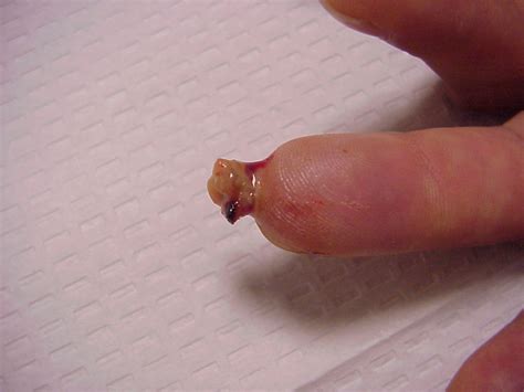 Pyogenic Granuloma Finger
