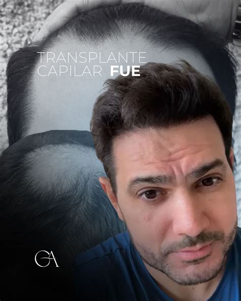 Dr Gustavo Amarante Transplante Capilar Drgustavoamarante • Instagram Photos And Videos