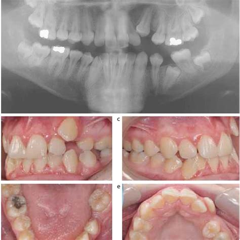 Case 3 Nm Aged 20 Years A Opt 2011 Showing Ectopic Premolar Units