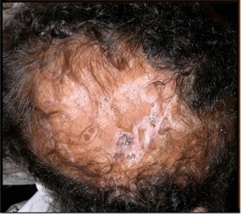 Atrophic Scaring Of The Vertex Representing Aplasia Cutis Congenita 2
