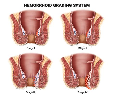 Rectal Hemorrhoid