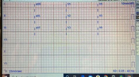 Ali Sovari Md Facc Fhrs On Linkedin Ecg Electrocardiology