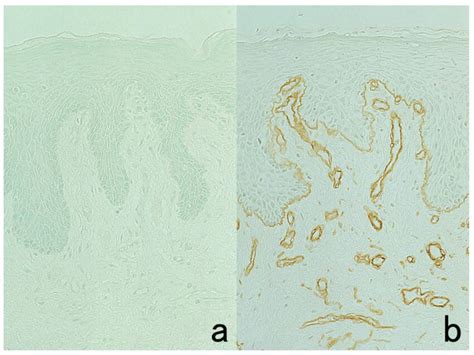 Effect Of Trypsin Digestion In Immunostaining For Type 4 Collagen In