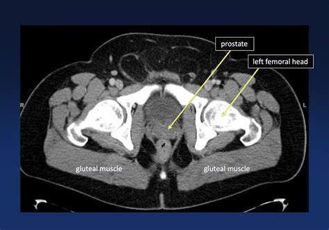 Ct Anatomy Pelvis Muscles Presentation1 Pptx Ct Normal Anatomy Of The Abdomen And Pelvis