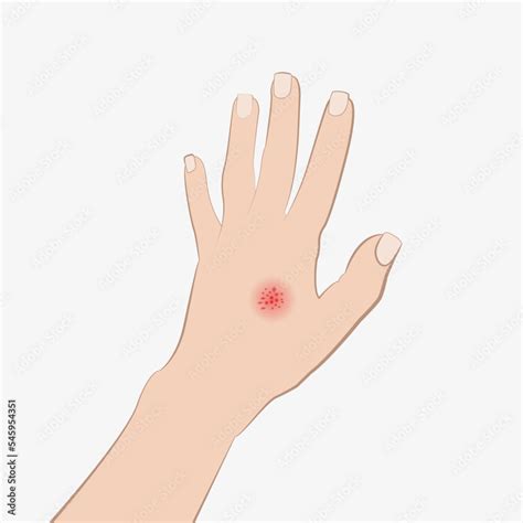 A Womans Hand With An Image Of Redness And Rashes Signs Of Atopic