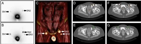 Preoperative Sentinel Node Mapping Following A Peritumoral Injection