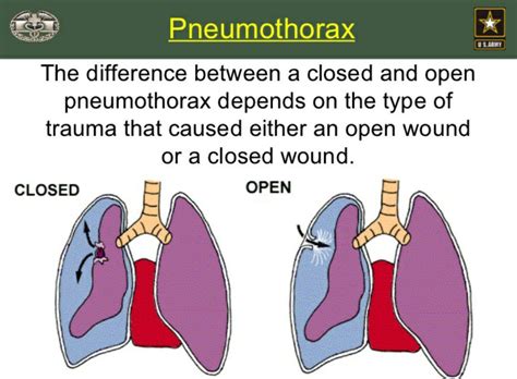Open Pneumothorax