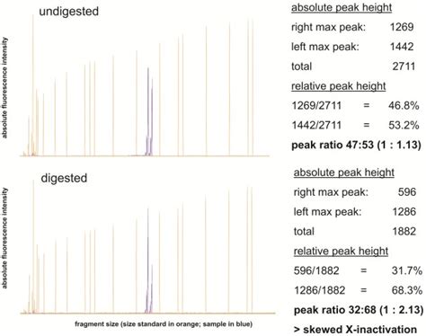 X Inactivation Analysis Demonstrating Skewed Inactivation In The Female Download Scientific