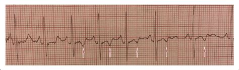Development Of T Wave Inversion T Inversions Are Shown With Red Arrow Download Scientific