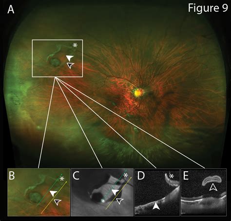 Pdf Peripheral Oct And Ultrawide Field Color Image Of Retinal Tear