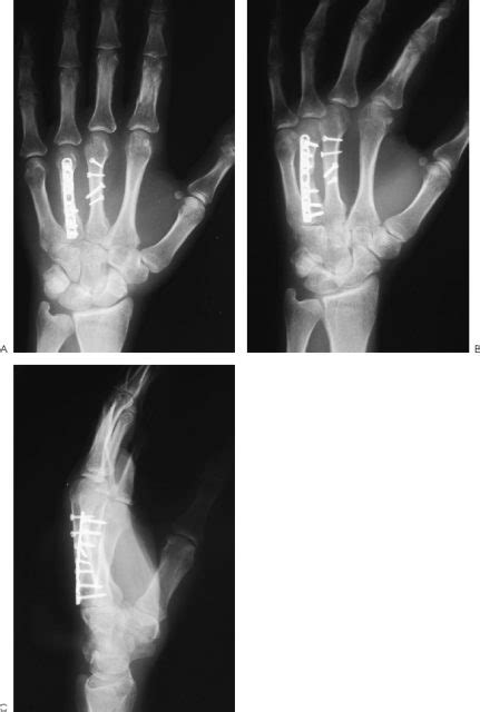 Metacarpal Shaft Fractures Plastic Surgery Key