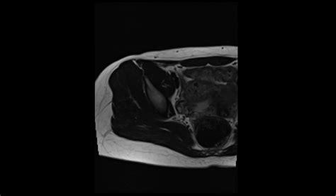 Appendix Mri T2 Tse Axial Images