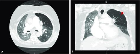 A Transverse View Of The Ct Chest Showing Hyperlucent Left Upper Lobe Download Scientific