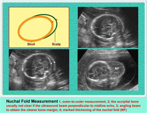 Nuchal Fold Thickness At 21 Weeks Eiyub