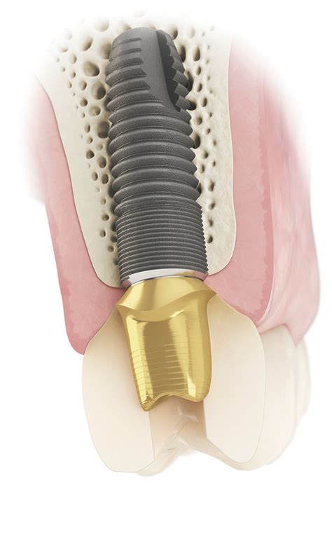 Atlantis Abutment Und Atlantis Crown Endlich Vereint Dentalwelt