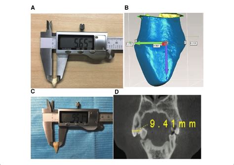 A Manual Measurement Of Extracted Primary Teeth With A Vernier