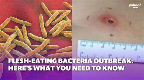 Cases Of Flesh Eating Bacteria Increase In Australia Heres What You
