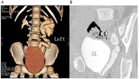 Left Side Congenital Megaureter A Volume Rendering And B
