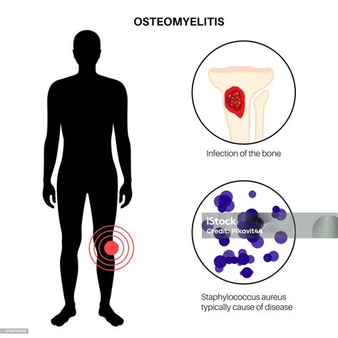 Tibia Bone Osteomyelitis Stock Illustration Download Image Now Chronic Illness Acute Angle