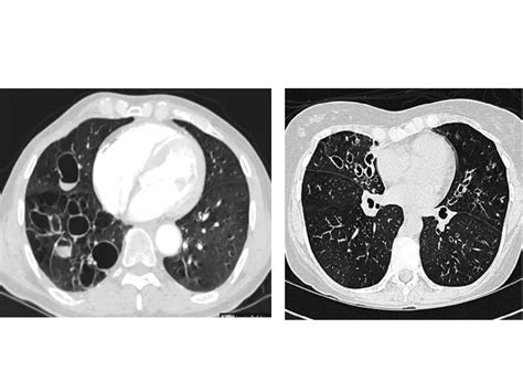 Interstitial Lung Disease Radiology Pptx