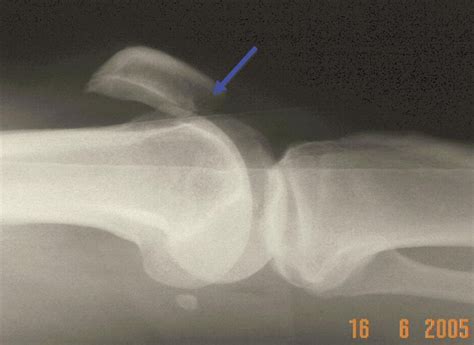 Superior Dislocation Of The Patella Case Report And Review Of The