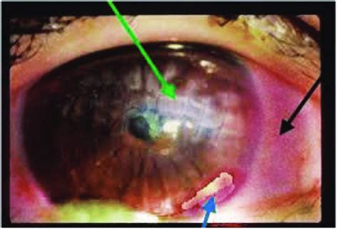 Klebsiella Oxytoca Induced Keratitis Showing Hypopyon Redness Ulcer Download Scientific