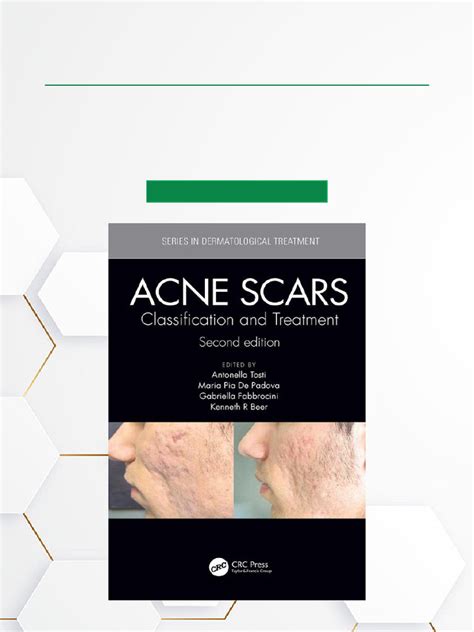 Acne Scars Classification And Treatment Pdf Scar Dermatology
