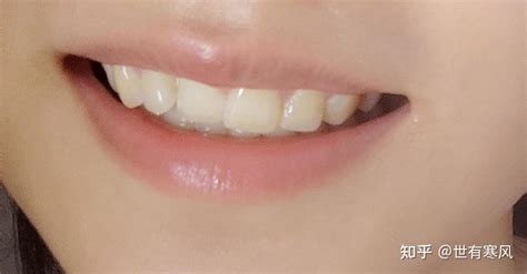 门牙不齐需要矫正吗？一直很自卑 知乎