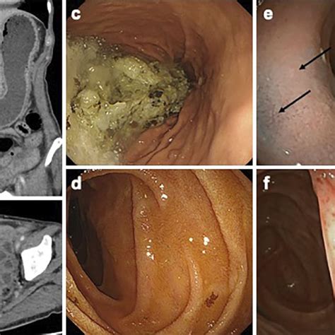 Figure2the Findings Of Computed Tomography Ct And Gastrointestinal