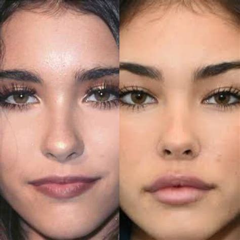 Madison Beer Plastic Surgery Face Surgery Celebrity Plastic Surgery Plastic Surgery