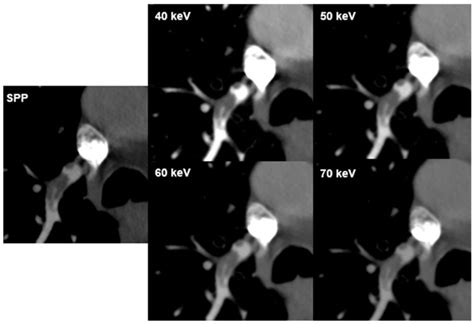 Impact Of Photon Counting Detector Ct Derived Virtual Monoenergetic Images On The Diagnosis Of