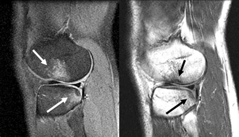 Bone Marrow Oedema Like Signal Related To Anterior Cruciate Ligament Download Scientific