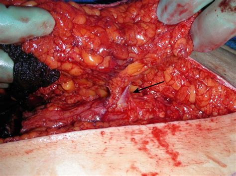 Sacral Reconstruction Plastic Surgery Key