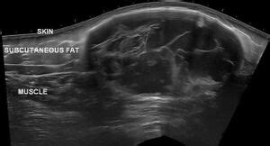 Quadriceps Hematoma Aspiration Wikism Sports Medicine Wiki