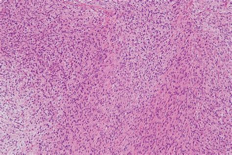 Low Grade Fibromyxoid Sarcoma Wikipedia