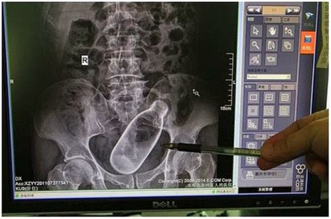 Pelik Lelaki China Masuk Botol Dalam Dubur Untuk Rawat Sembelit Gaban Comel