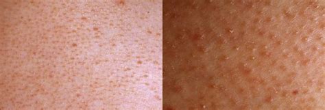 Why Do I Have A Lot Of Red Bumps On My Chest Design Talk