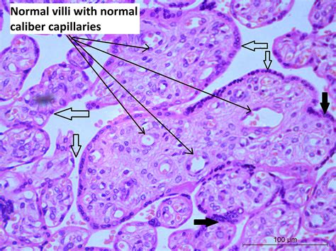 Chorionic Villi Histology