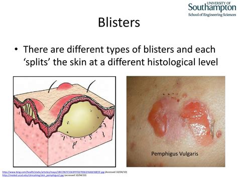 Ppt Some Aspects Of Skin Tribology Friction Blister Powerpoint