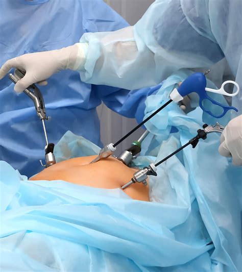 Intermediate Laparoscopic Surgery