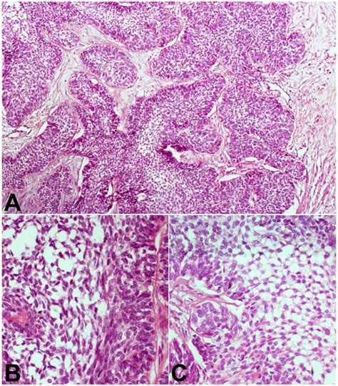 Malignant Ameloblastoma Vs Ameloblastic Carcinoma