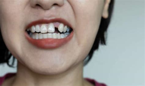 How Can I Replace My Missing Teeth Roots And Gums Of The Tri Valley